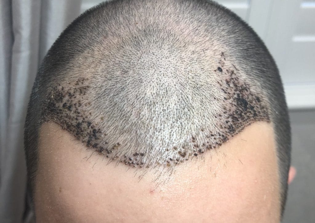 Chris 1 Week After Hair Transplant Hairpalace