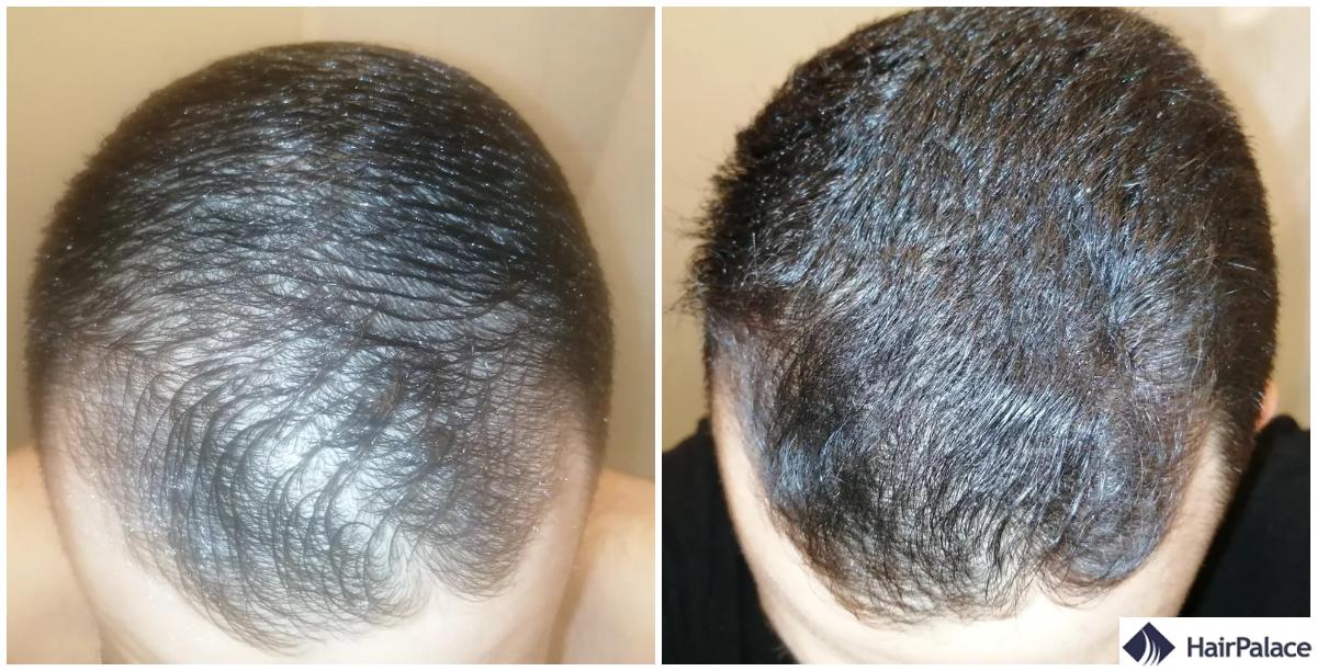 Dermaroller Cheveux | TOP 5 Choix en 2026